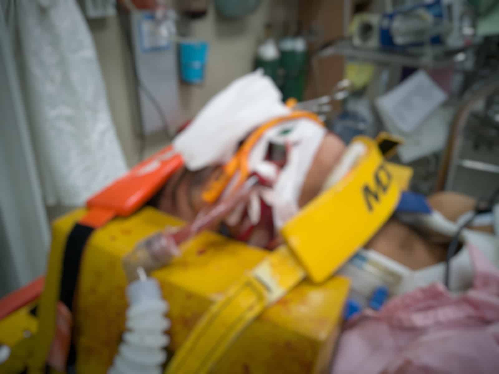 Severe Traumatic Brain Injury